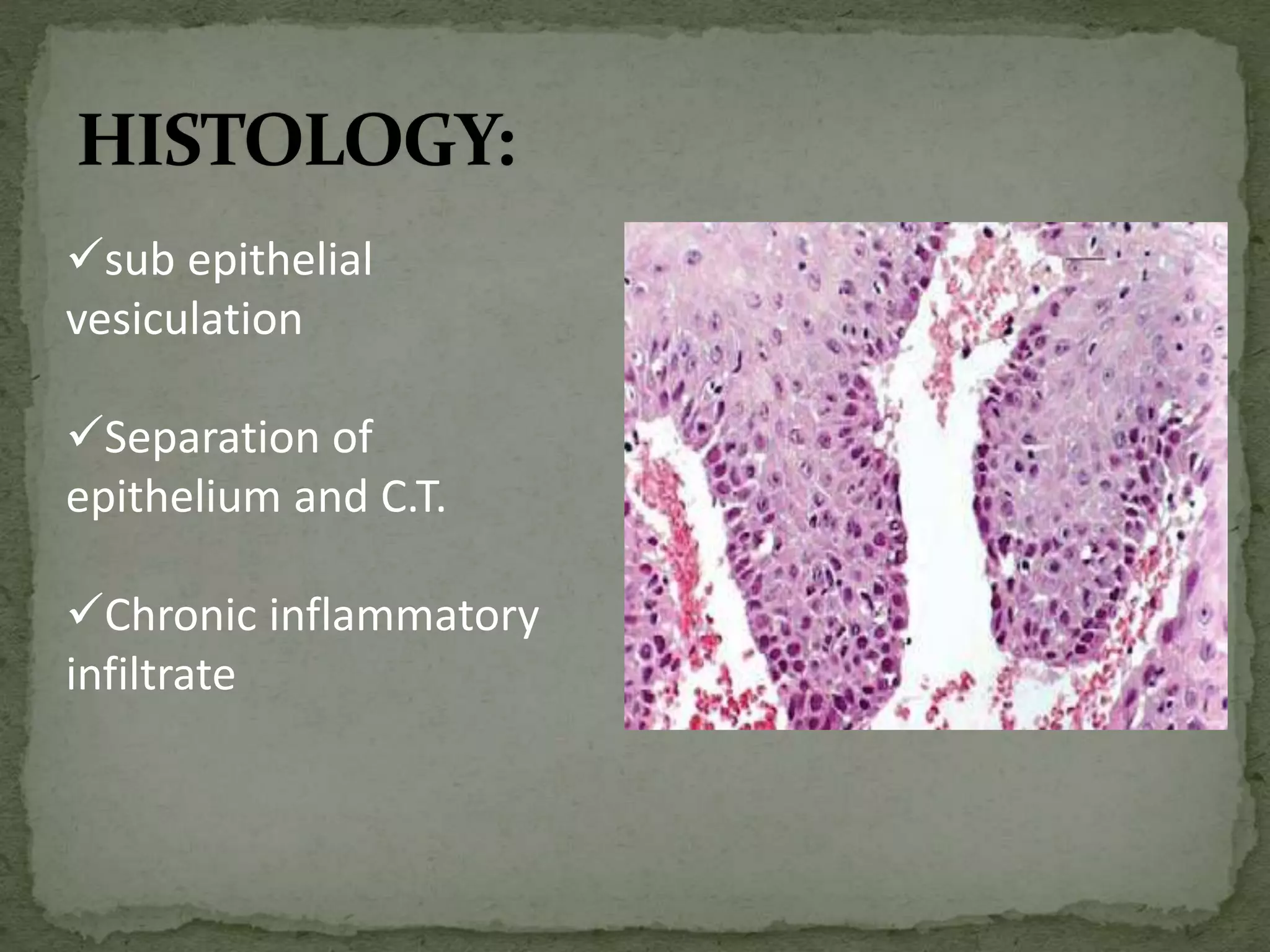 Desquamative Gingivitis | PPTX