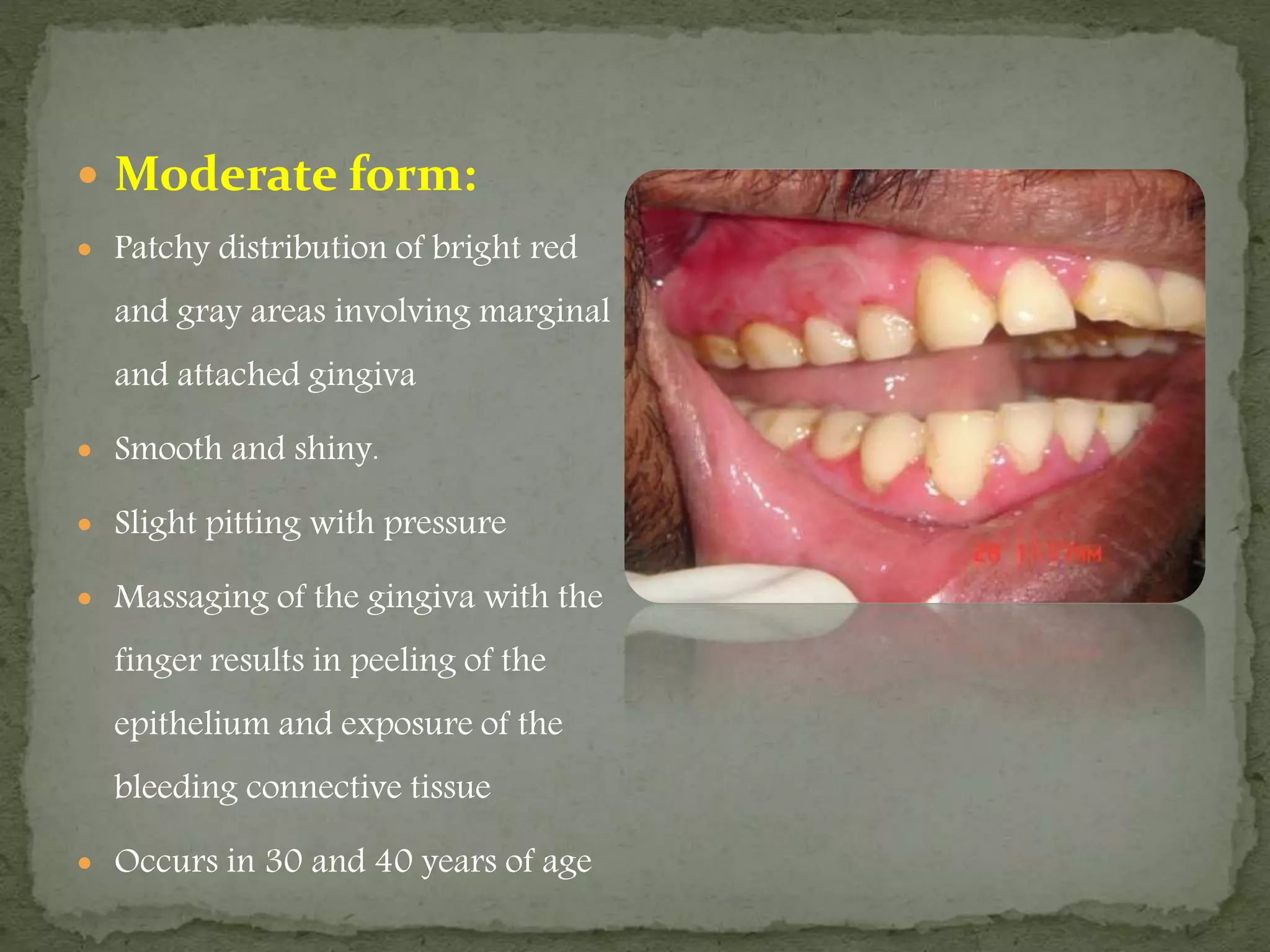 Desquamative Gingivitis | PPTX