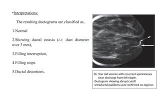 NIPPLE DISCHARGE AND SURGICAL MANAGEMENT | PPTX | Skin and Dermatology ...