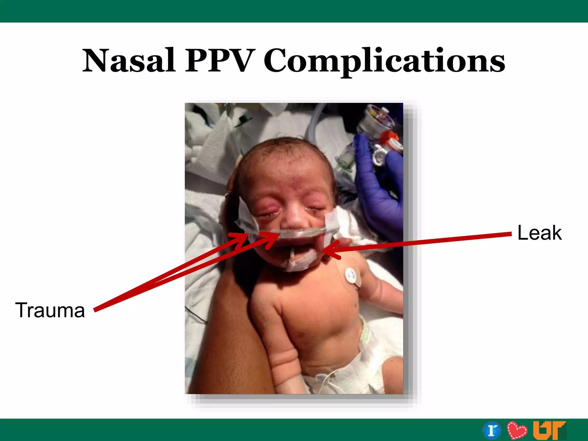 Non-Invasive Ventilation for Preterm Infants | PPTX