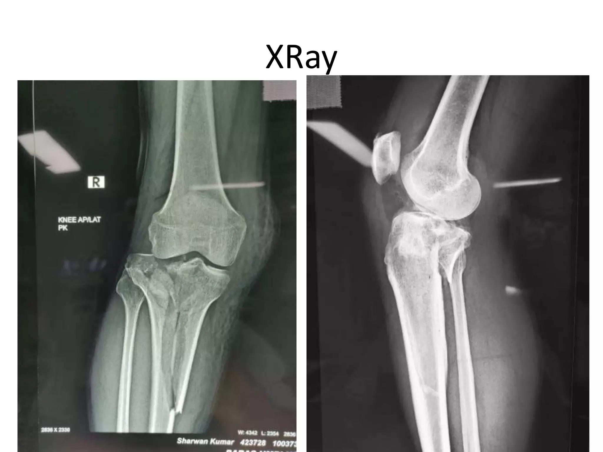 Proximal tibia fracture | PPT