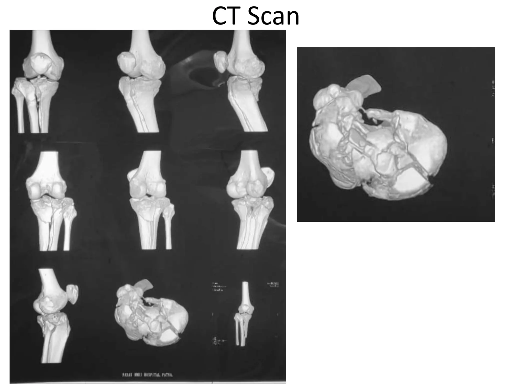Proximal tibia fracture | PPT