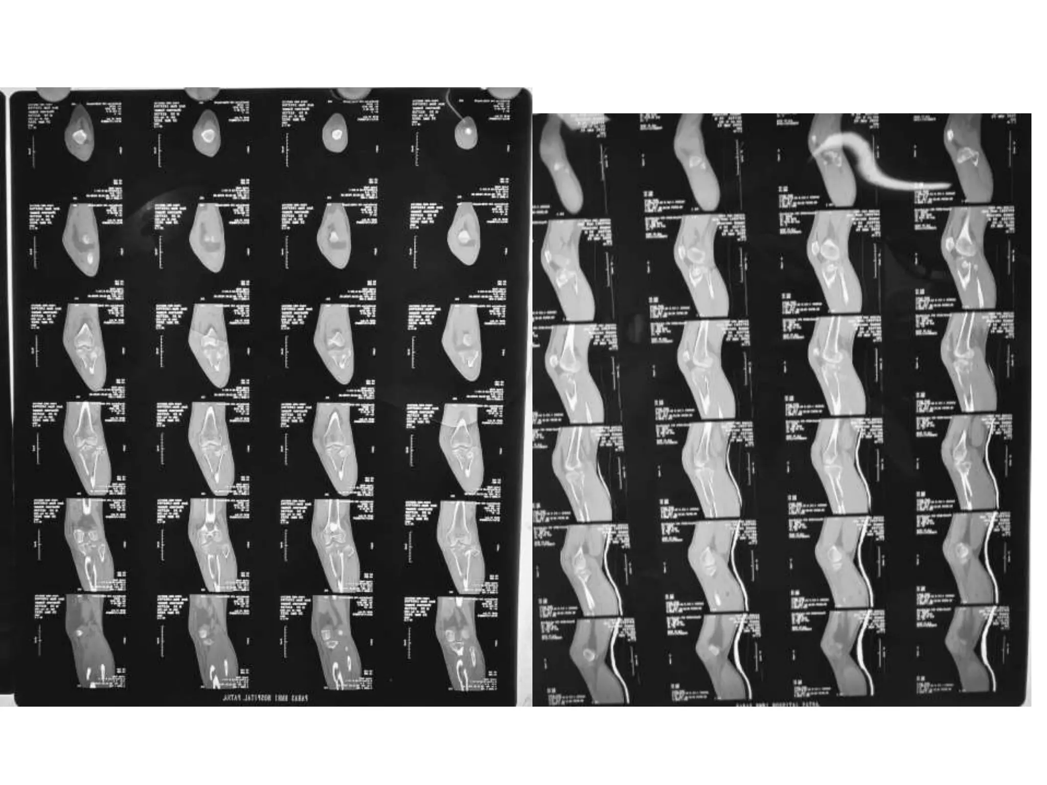 Proximal tibia fracture | PPT