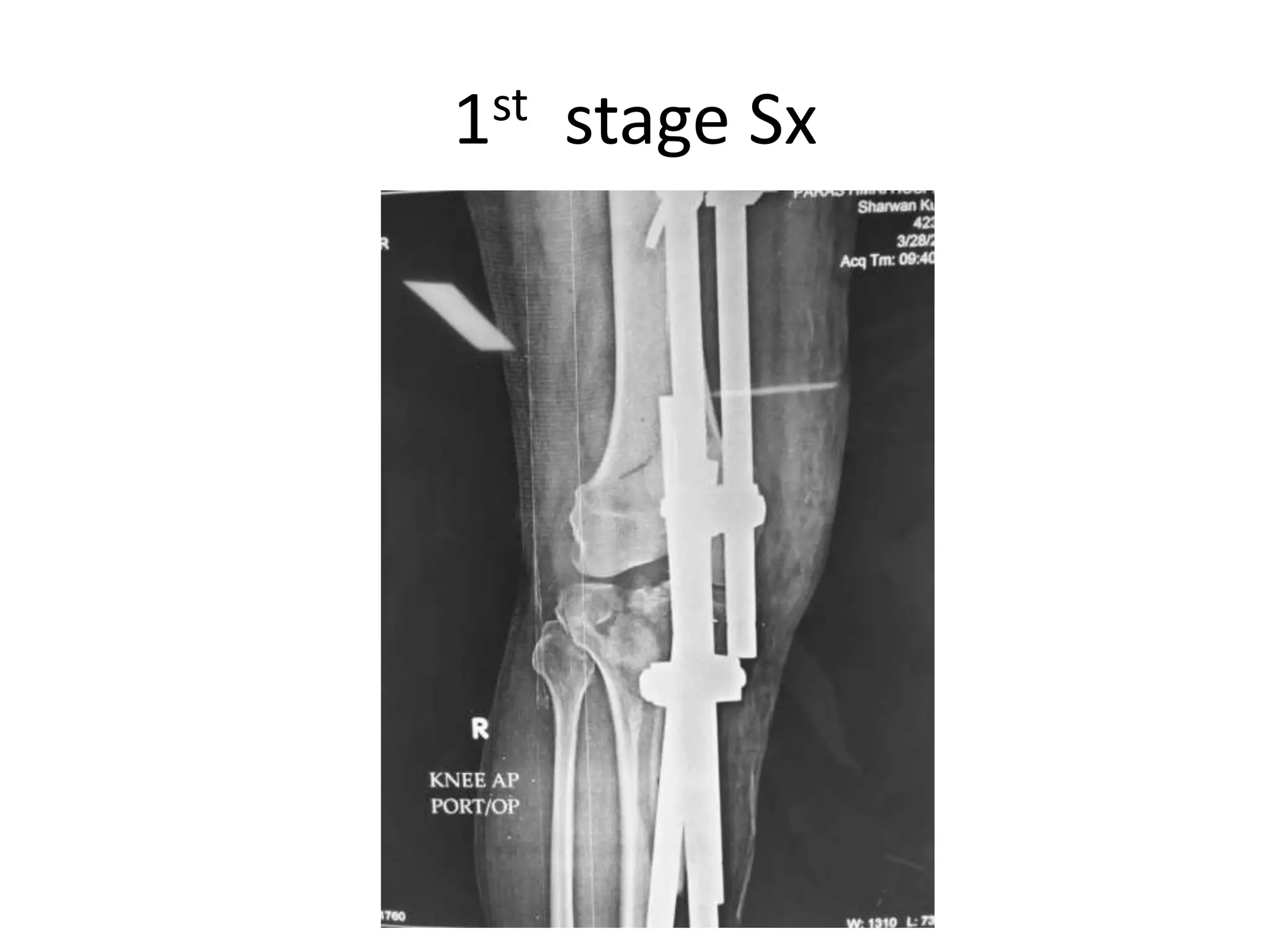 Proximal tibia fracture | PPT