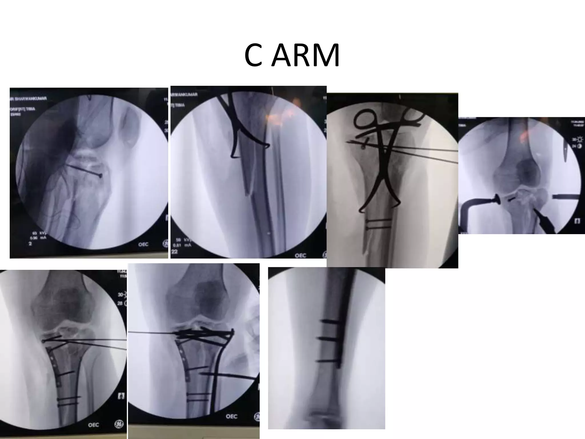 Proximal tibia fracture | PPT
