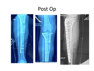 Proximal tibia fracture | PPT