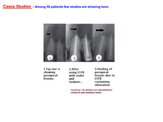 LSTR 3mix MP important efficacy particularly antibacterial and ...