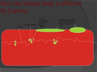 leprosy disease ppt Represented bynirjesh kumar mgip lucknow | PPT