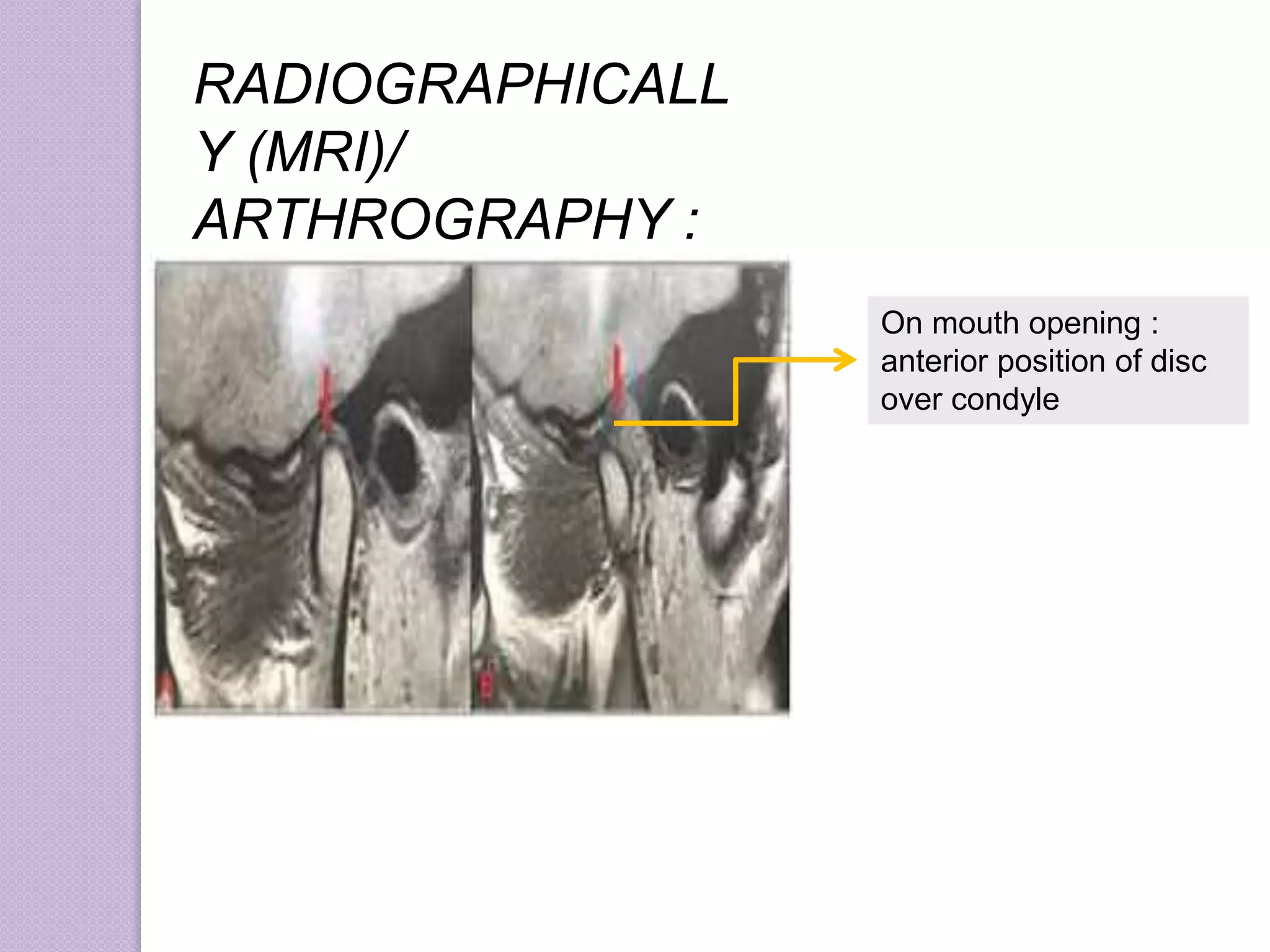 TMJ (temporomandibular joint) disorders | PPTX
