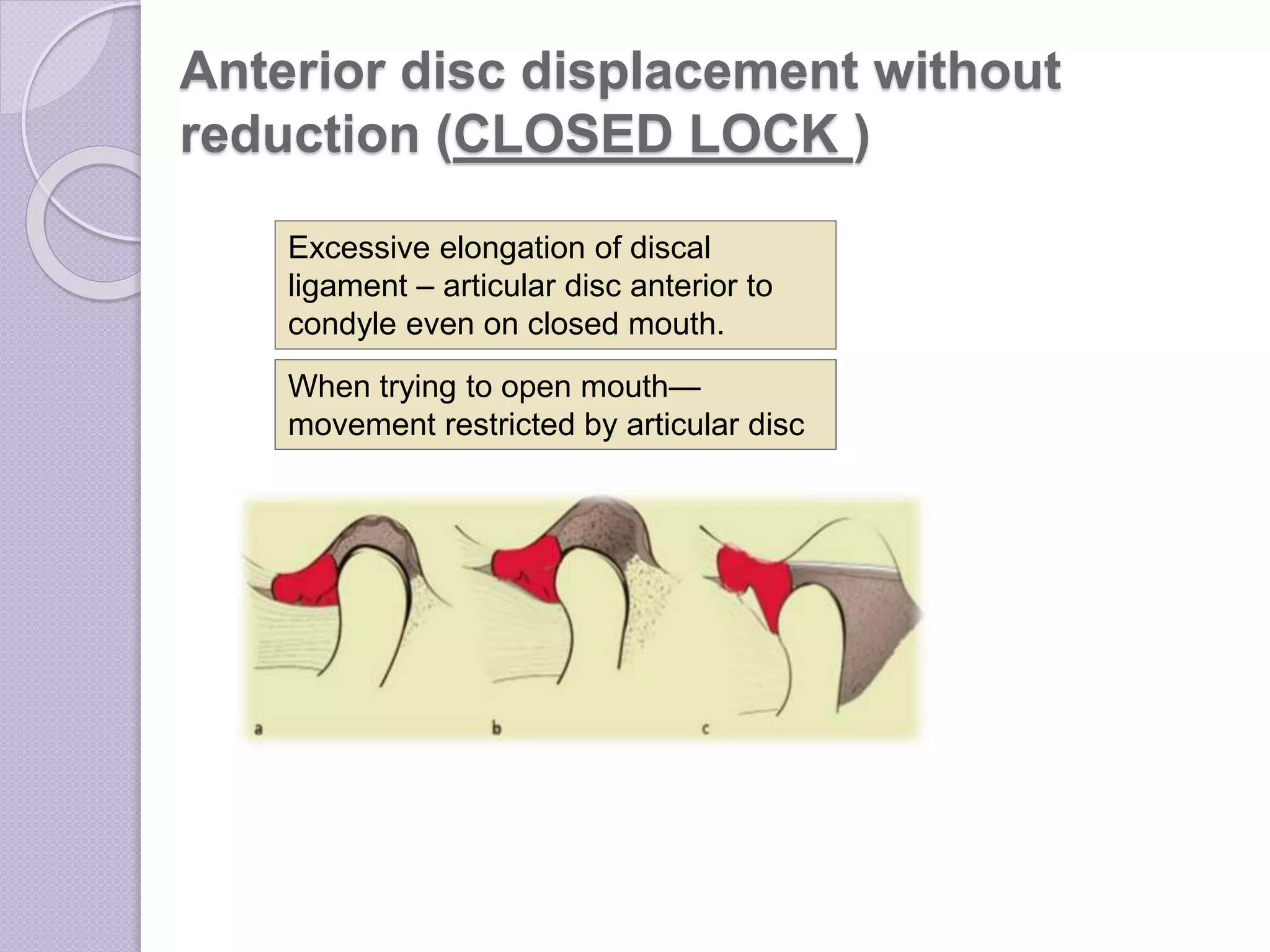 TMJ (temporomandibular joint) disorders | PPTX