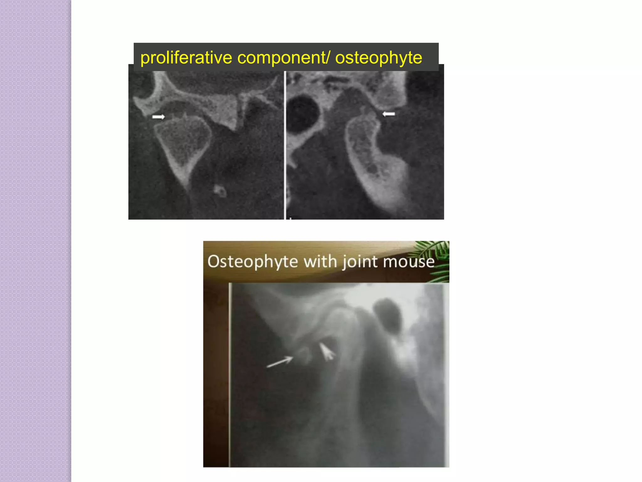 TMJ (temporomandibular joint) disorders | PPTX