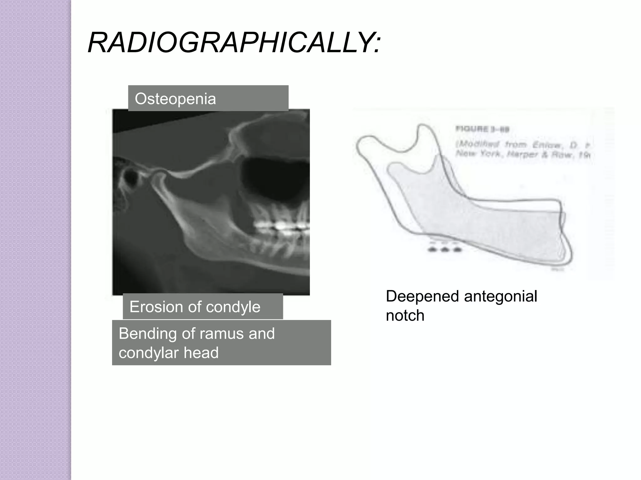 TMJ (temporomandibular joint) disorders | PPTX