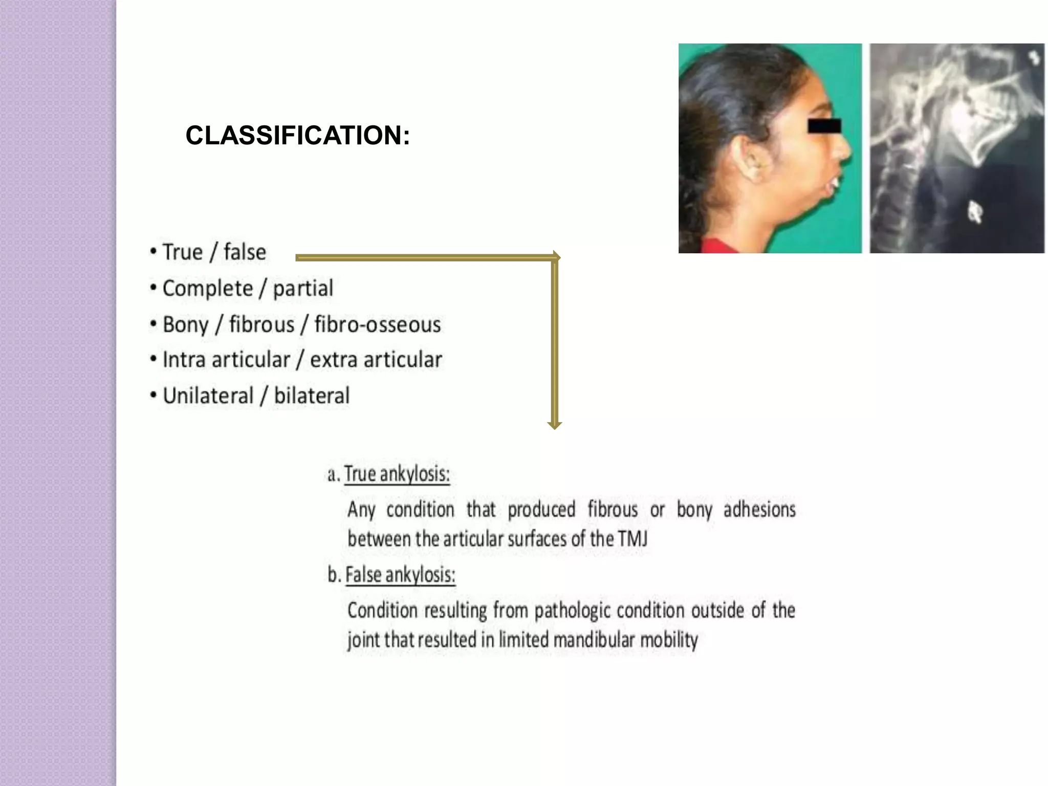 TMJ (temporomandibular joint) disorders | PPTX