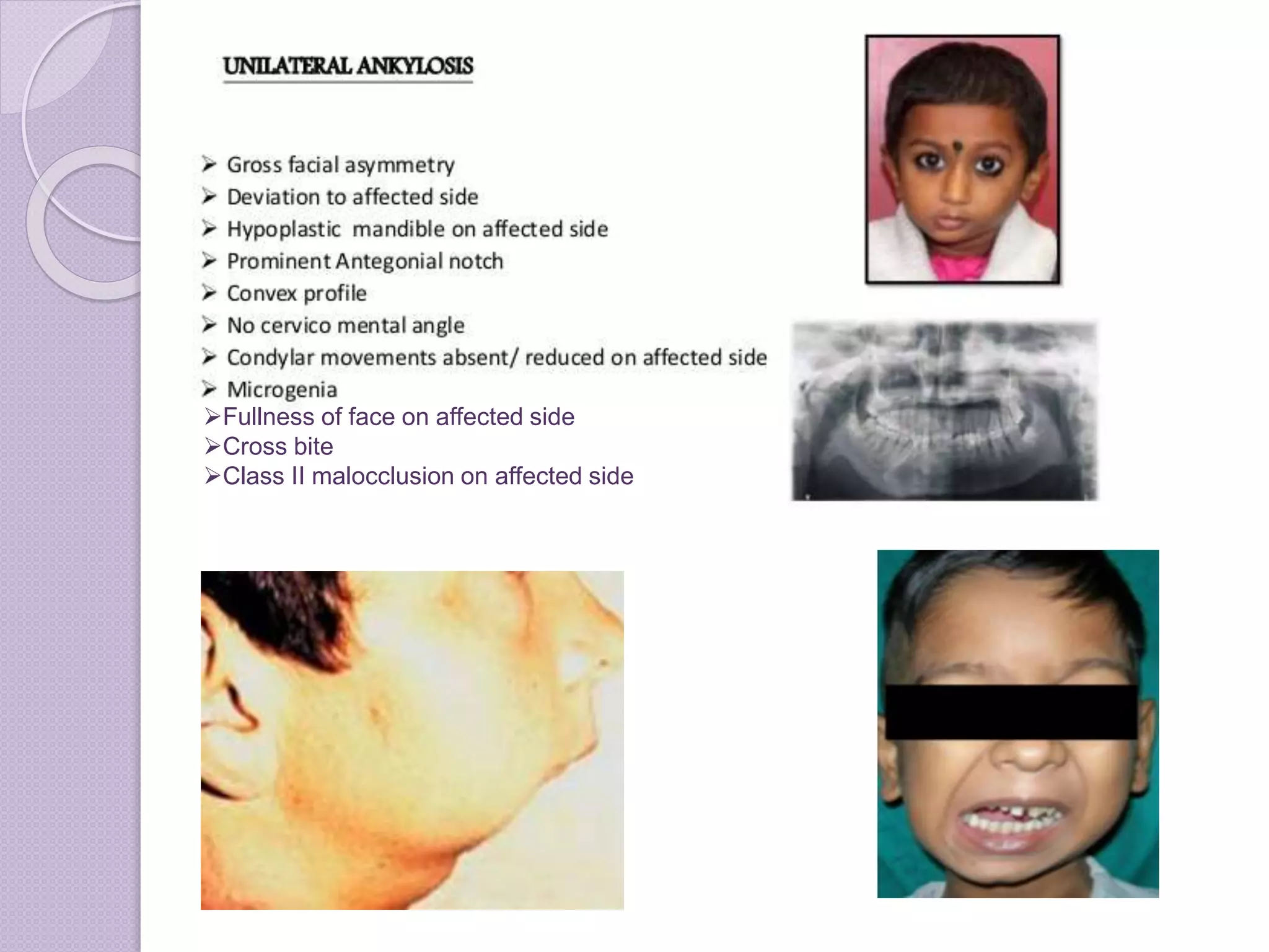 TMJ (temporomandibular joint) disorders | PPTX