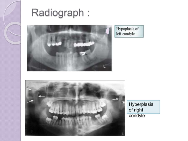 TMJ (temporomandibular joint) disorders | PPTX | Bone and Joint ...