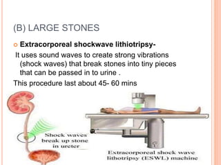 NEHA VERMA renal calculi ppt.pptx