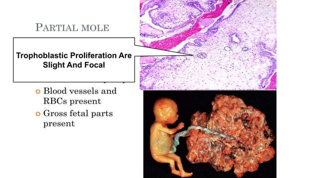 Gestational Trophoblastic Disease( GTD)- Molar pregnancy, Gestational ...