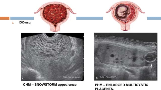 Gestational Trophoblastic Disease( GTD)- Molar pregnancy, Gestational ...