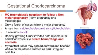 Gestational Trophoblastic Disease( GTD)- Molar pregnancy, Gestational ...
