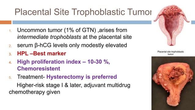 Gestational Trophoblastic Disease( GTD)- Molar pregnancy, Gestational ...
