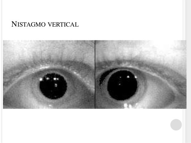 Nistagmo