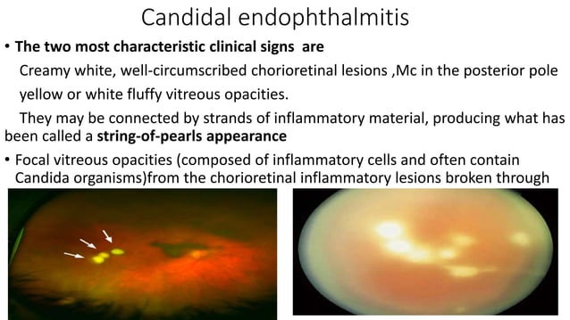 Nitin endophthalmitis prevention and management | PPT