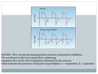 NON INVASIVE VENTILATION FOR MBBS STUDENTS | PPTX | Lung and ...