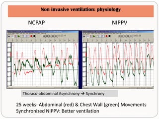 NON INVASIVE VENTILATION IN NEONATE | PPTX