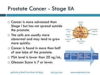 Stages of Prostate Cancer | PDF