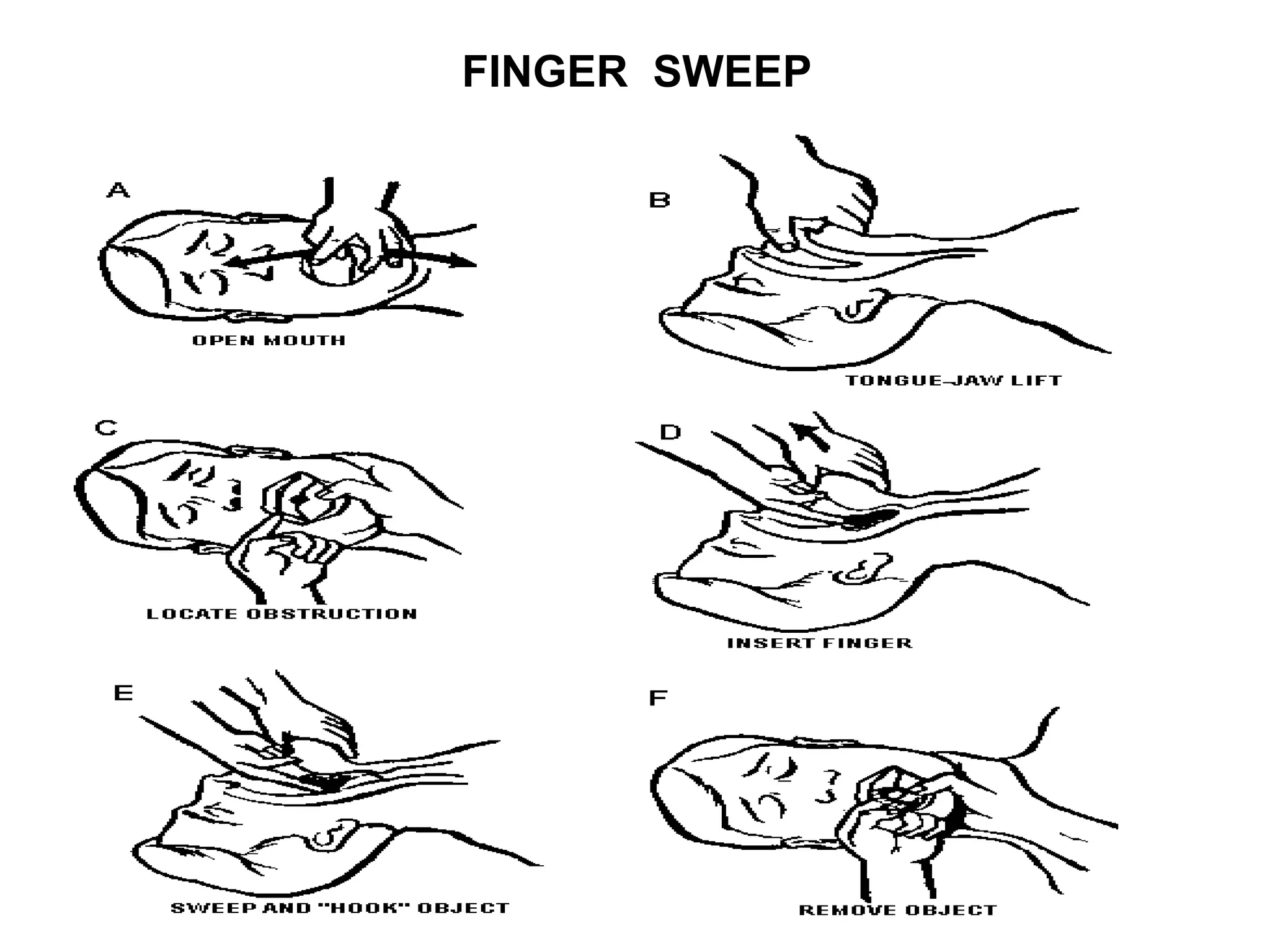 Airway obstruction with foreign bodies treatment in dental office | PPTX