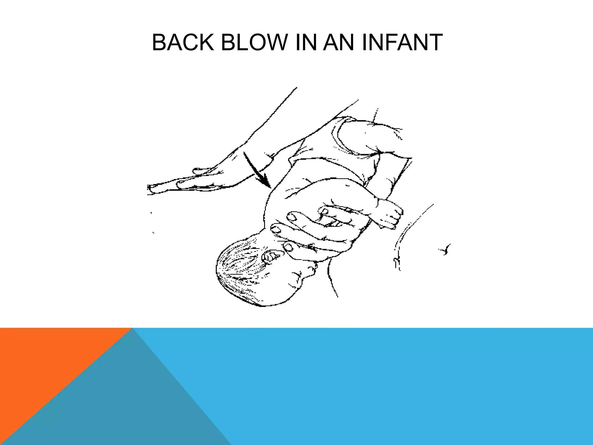 Airway obstruction with foreign bodies treatment in dental office | PPTX