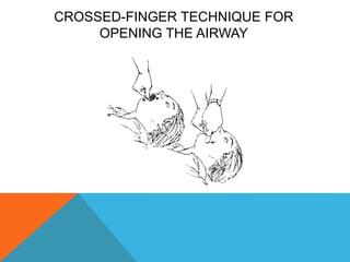 Airway obstruction with foreign bodies treatment in dental office | PPTX