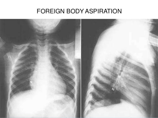 Airway obstruction with foreign bodies treatment in dental office