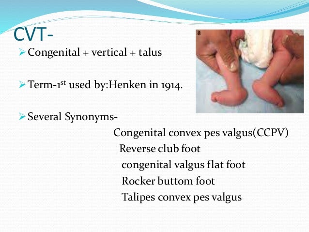 congenital vertical talus BY Dr Nk singh