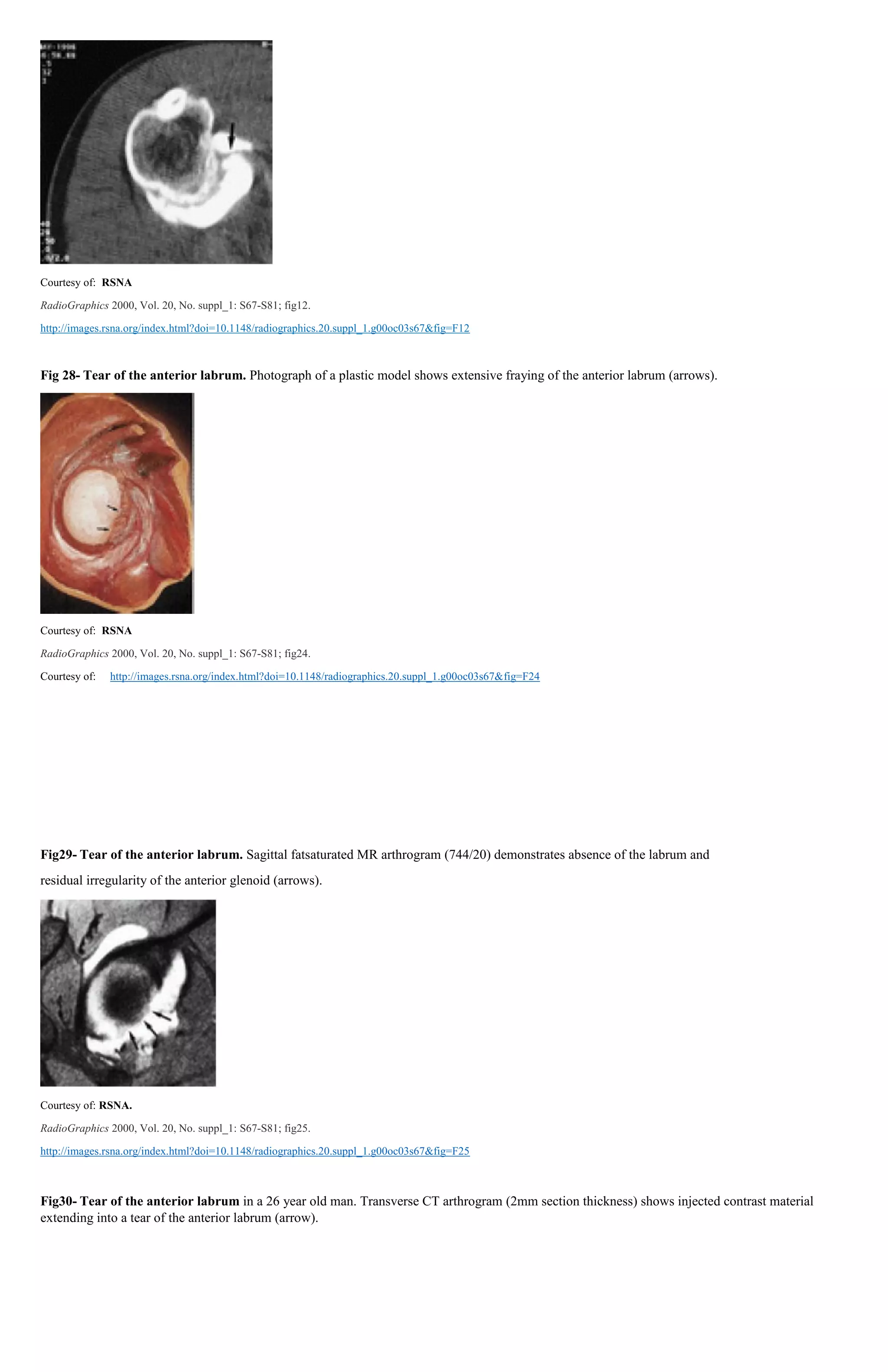 Normal Labral Variant Figures II - Walif Chbeir | PDF