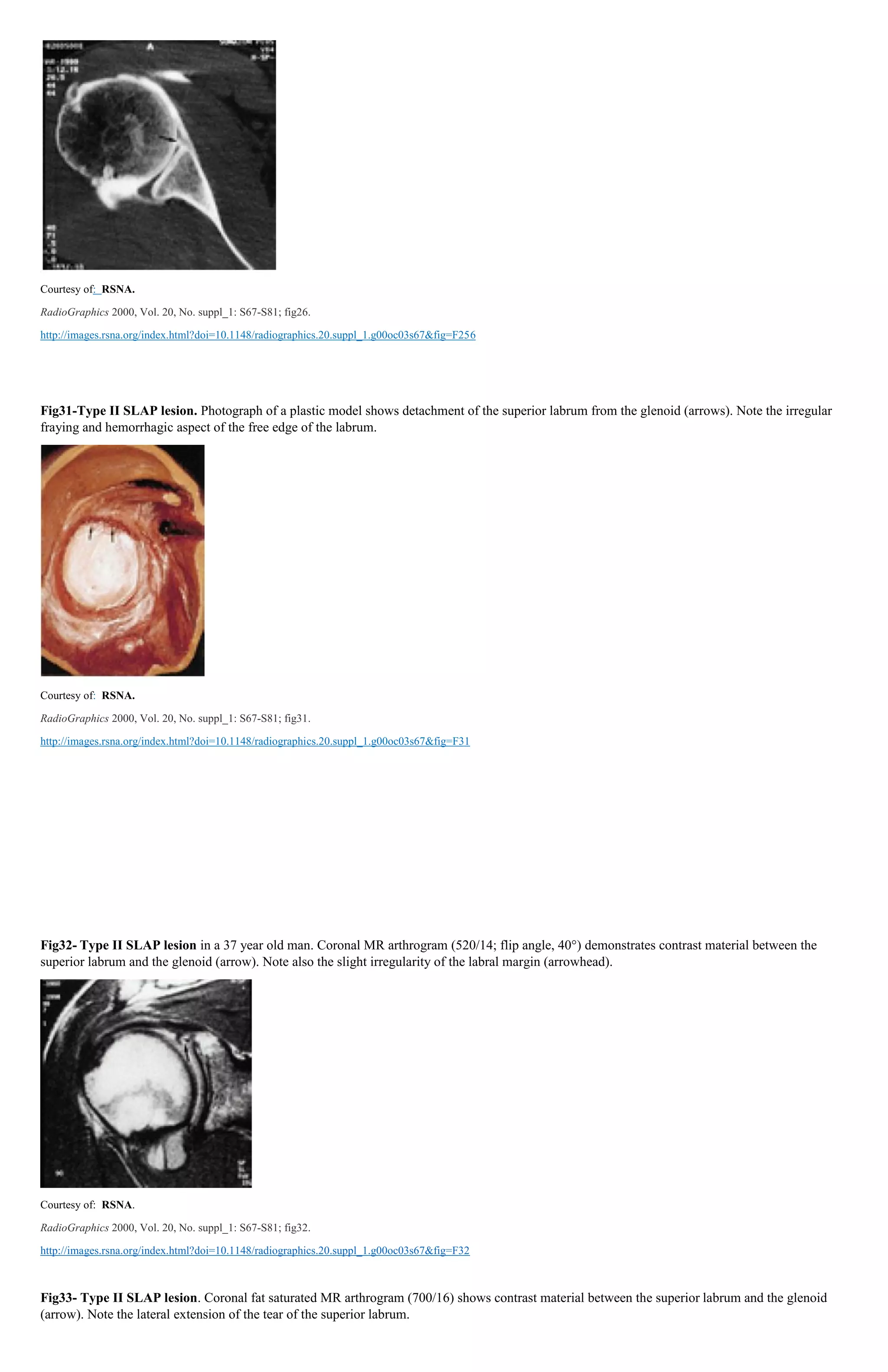 Normal Labral Variant Figures II - Walif Chbeir | PDF