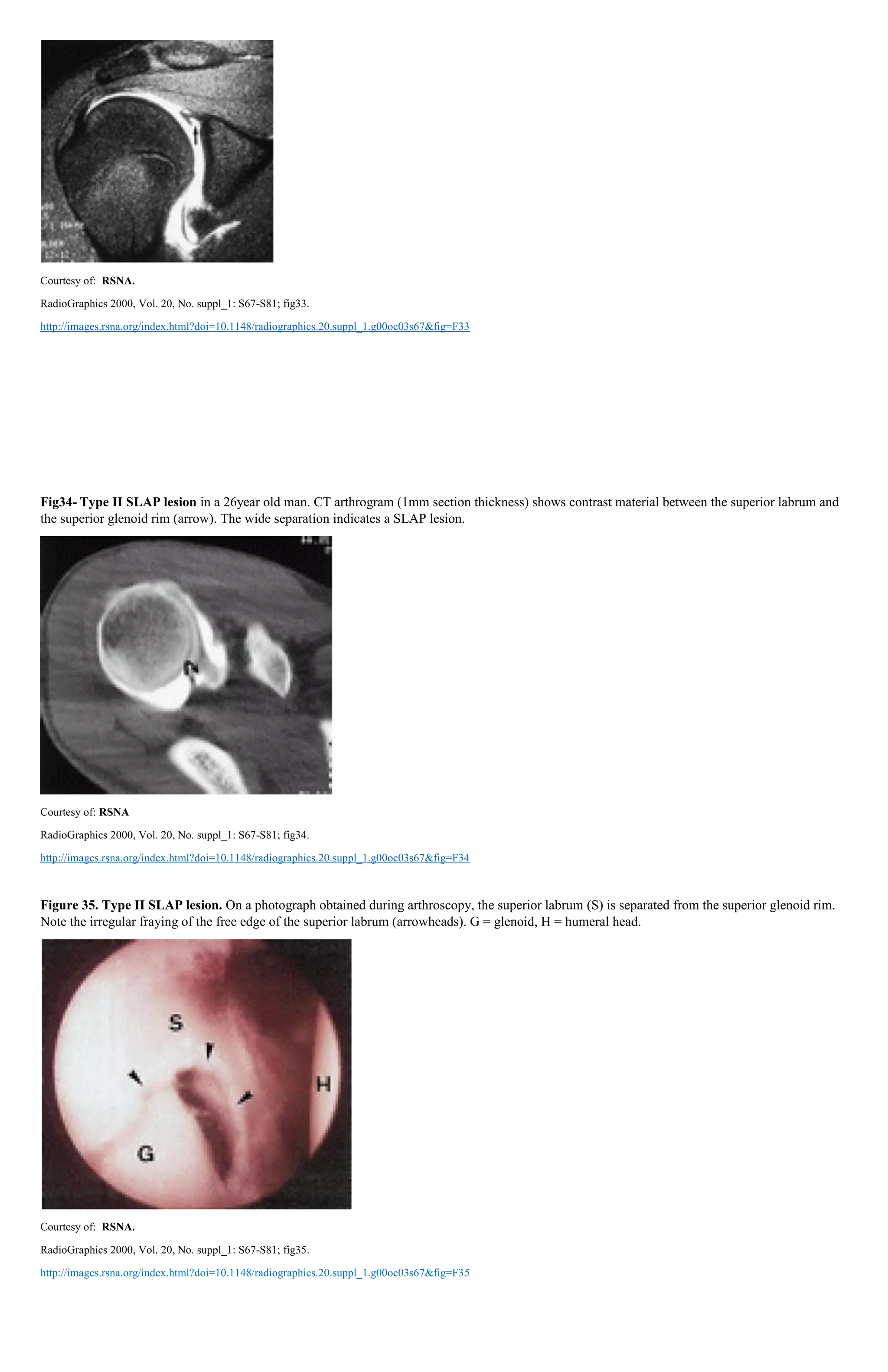 Normal Labral Variant Figures II - Walif Chbeir | PDF