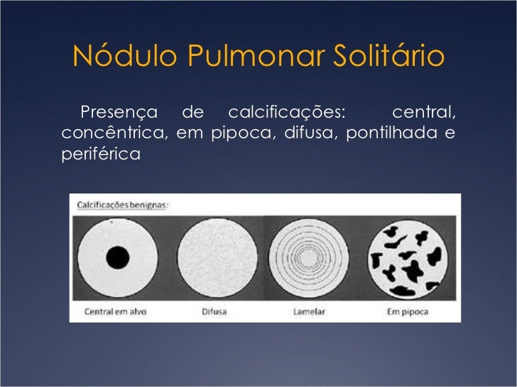 Aula 3: Nódulos e Massas Pulmonares