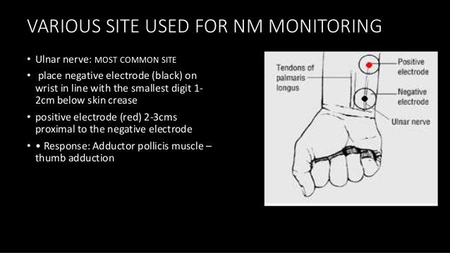 Neuromuscular Monitoring