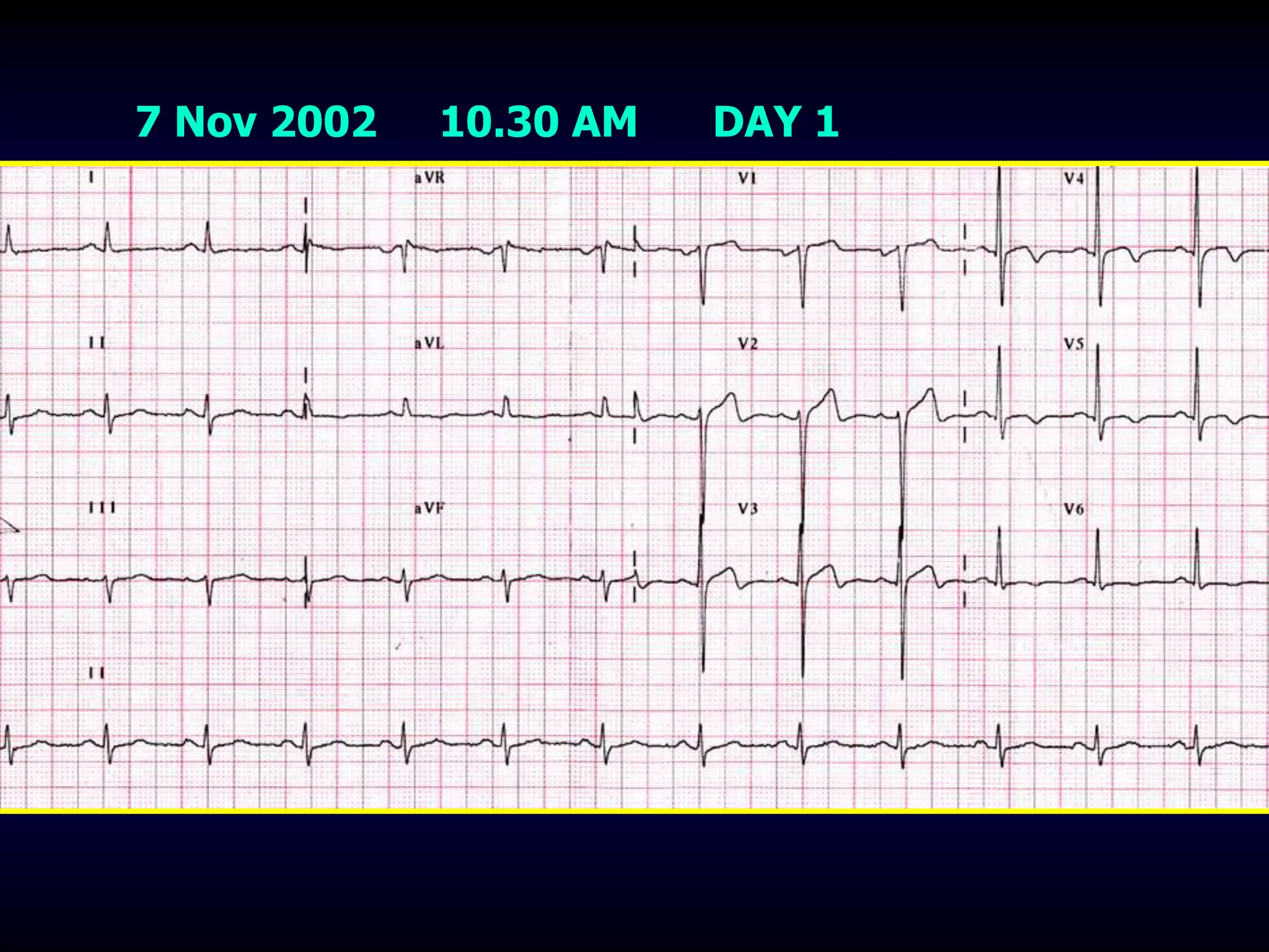 NMCT Cap. TS BS Hoai 2020.ppt