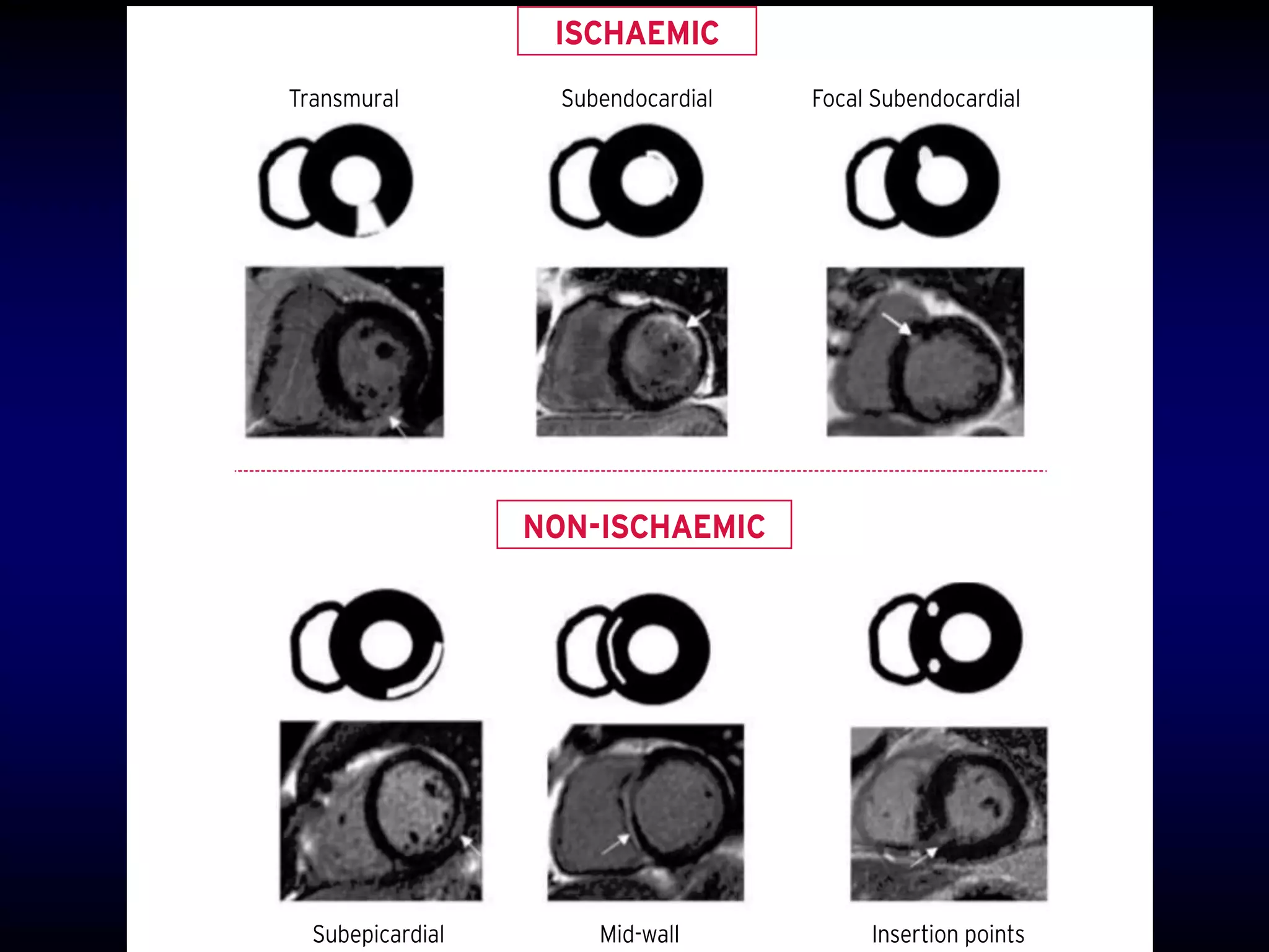 NMCT Cap. TS BS Hoai 2020.ppt
