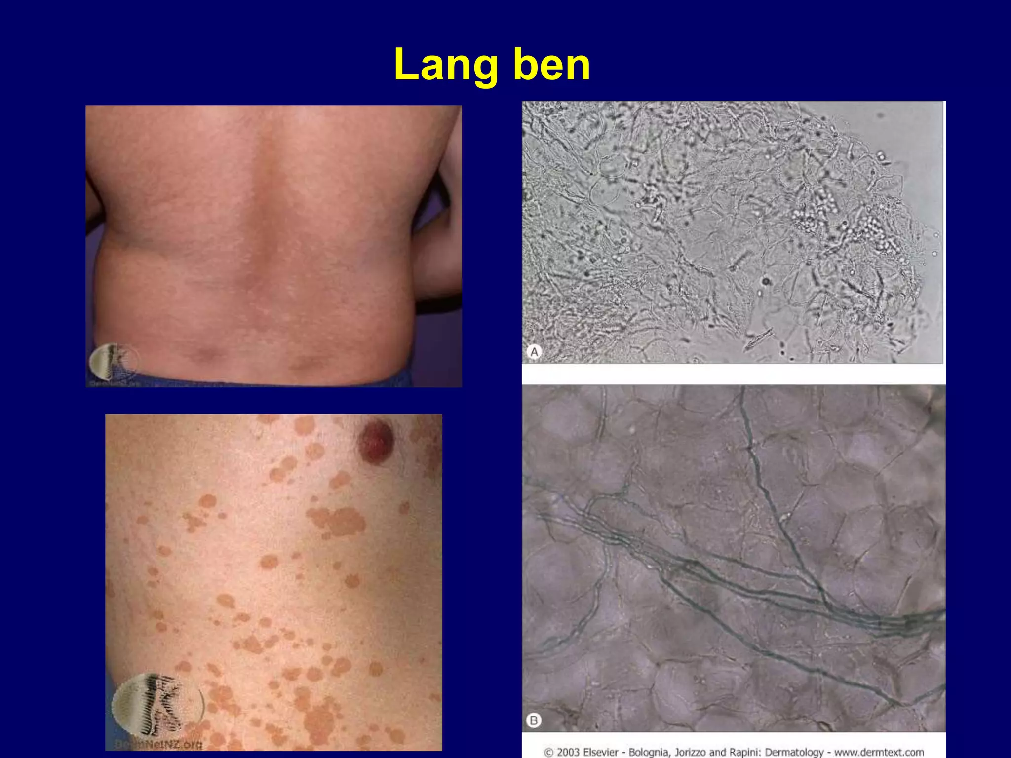 NẤM DA - TS BS TRẦN NGỌC ÁNH.pptx