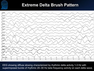 Anti-NMDA receptor encephalitis: Psychiatric presentation and ...