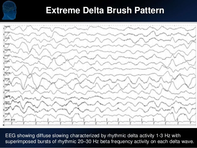 Anti-NMDA receptor encephalitis: Psychiatric presentation and diagnos…