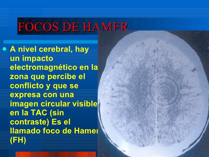 Nueva Medicina Germanica