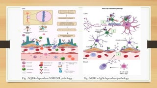 NMOSD(Neuromyelitis Optica Spectrum Disorder).pptx