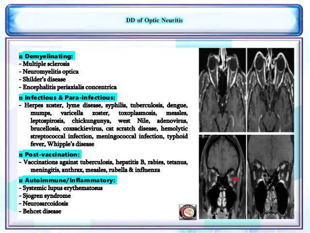 Neuromyelitis Optica Spectrum Disorder