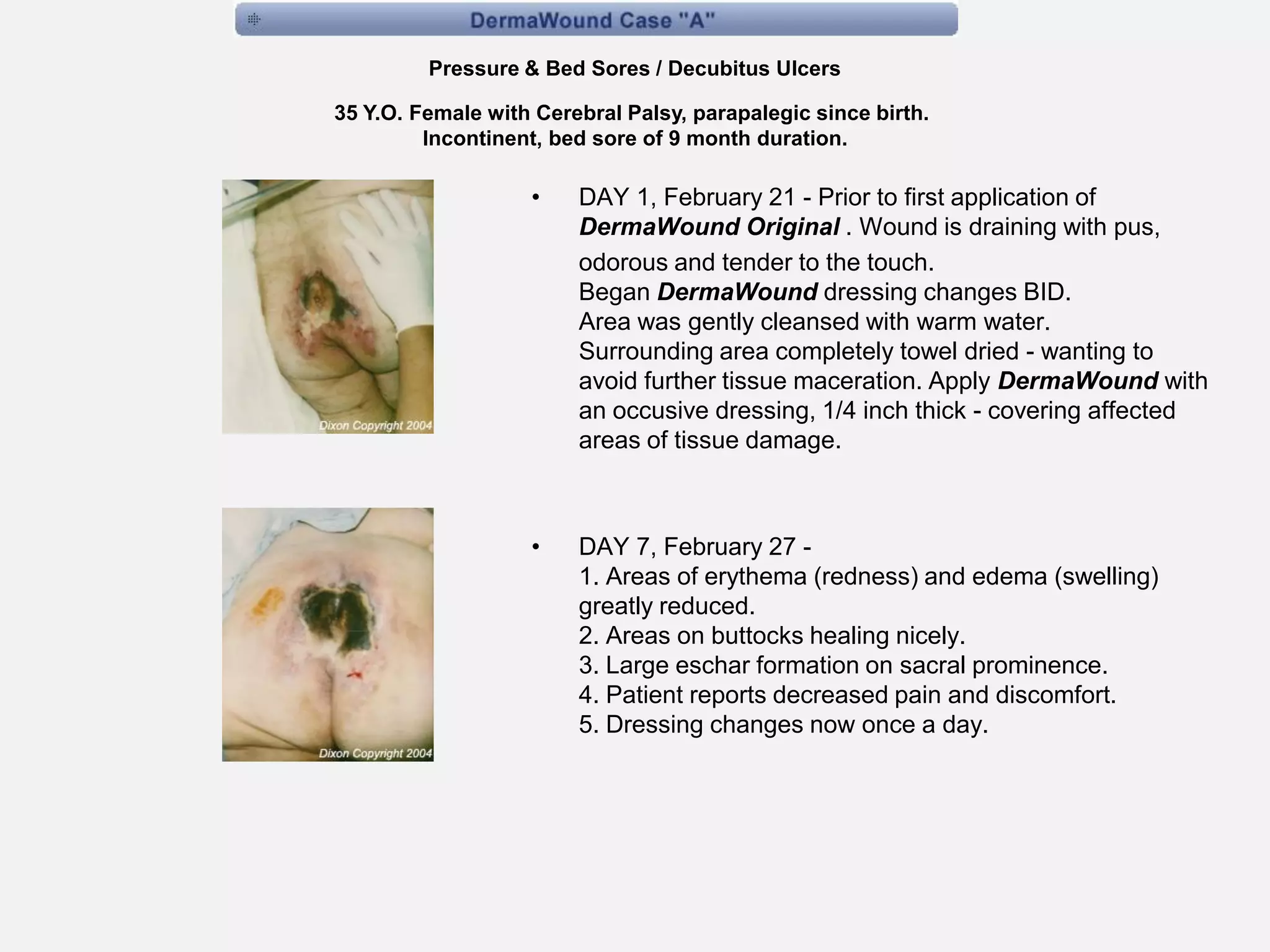 DermaWound for hard to heal woundcare | PDF