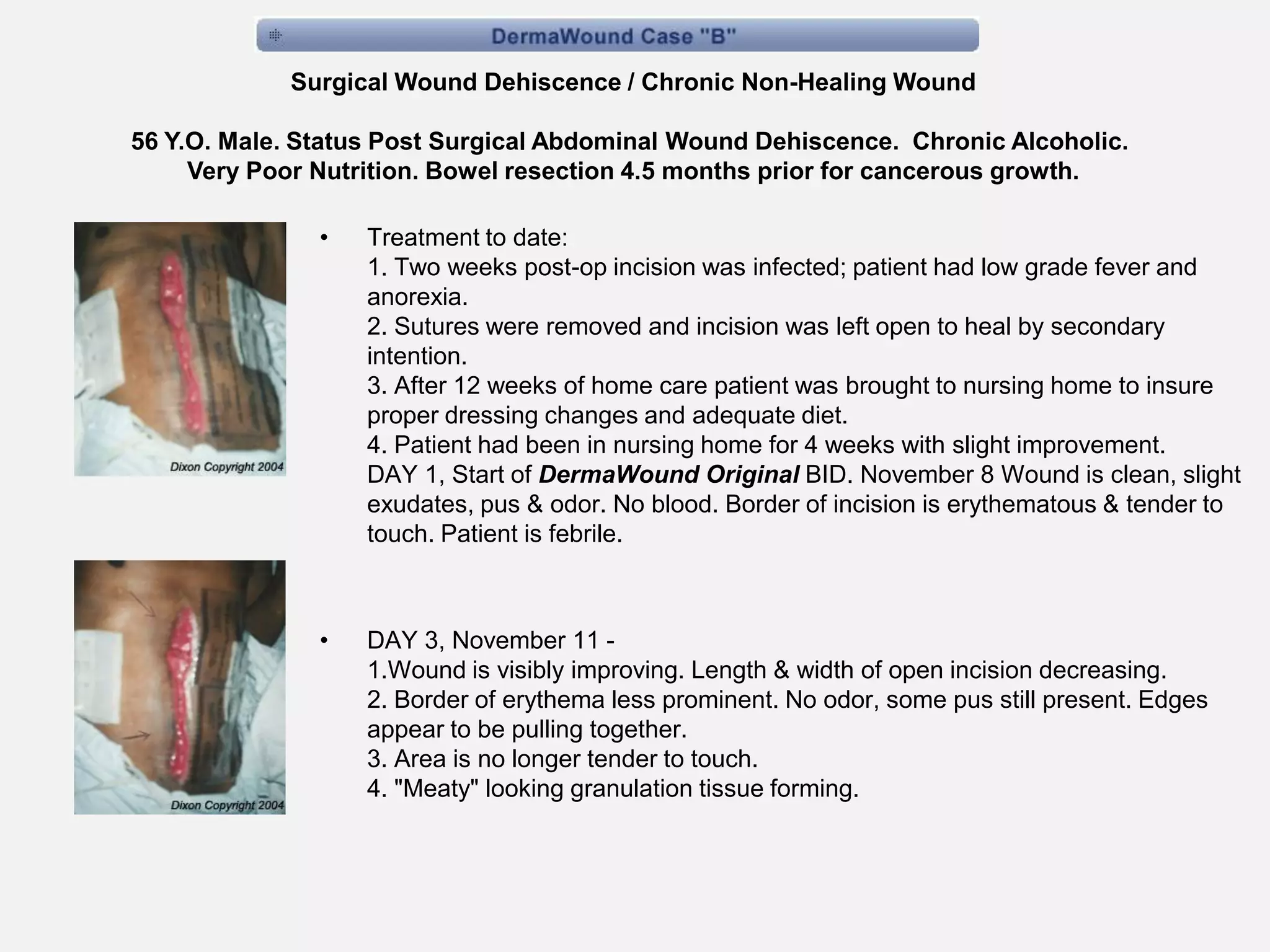 DermaWound for hard to heal woundcare | PDF | First Aid | Injuries