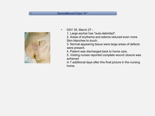 DermaWound for hard to heal woundcare | PDF